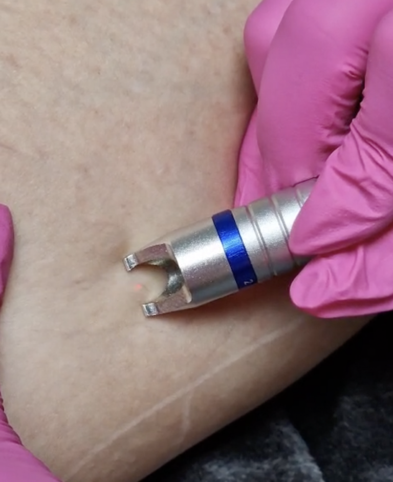 Removing vascular lesions on the face and body using lasers has become ...